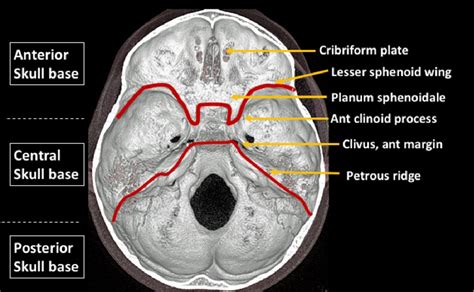 A Quiz About Skull Base Anatomy And Pathologies Make Learning Fun