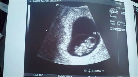 Parsons Bebe Ultrasound 8 Weeks