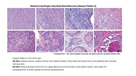 Who Classification Of Tumors Fifth Edition Pptx