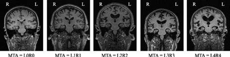 Visual Example Of Medial Temporal Atrophymta In Different Stages Of
