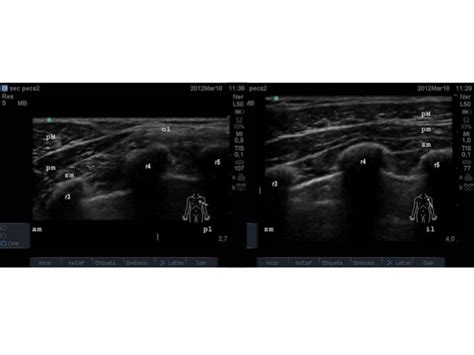 Pec I And Pecs Ii Serratus Anterior Block
