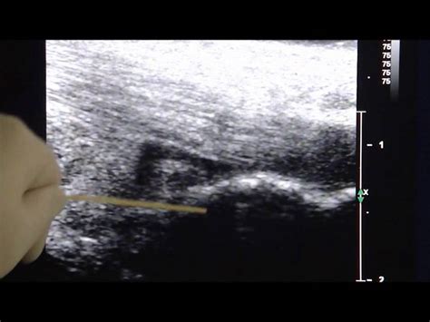 Cortisone Injection Retrocalcaneal Bursitis At Amber Mcleod Blog