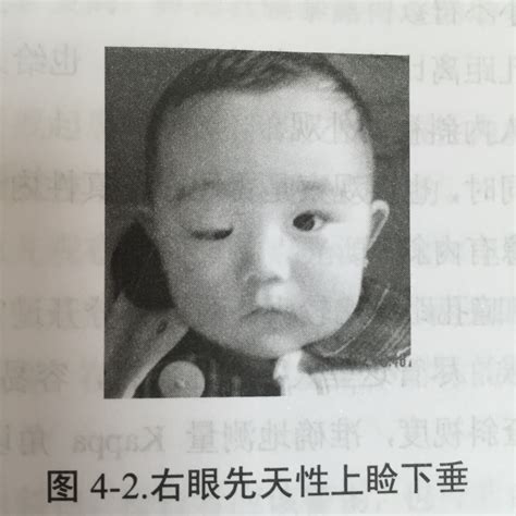 眼睑和睑裂 苏州大学理想眼科医院