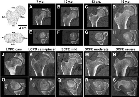 Figure 1 From Statistical Shape Modeling Of Proximal Femoral Shape