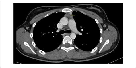 Ct Scan Of The Chest Showing Solid Nodularity Approximately 9 Mm In