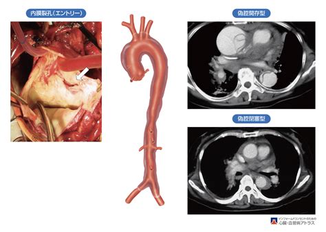 知られざる大動脈疾患｜胸部大動脈瘤・解離の診断と治療法【福本医院｜心斎橋】 福本医院