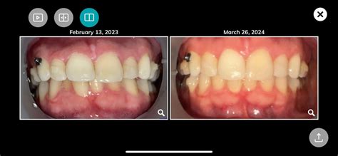 1 Year Progress 4 Trays To Go R Invisalign