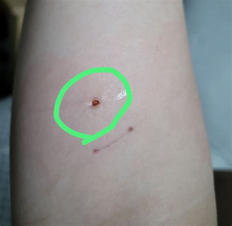 상처 사진 피부 아래 조직 지식in