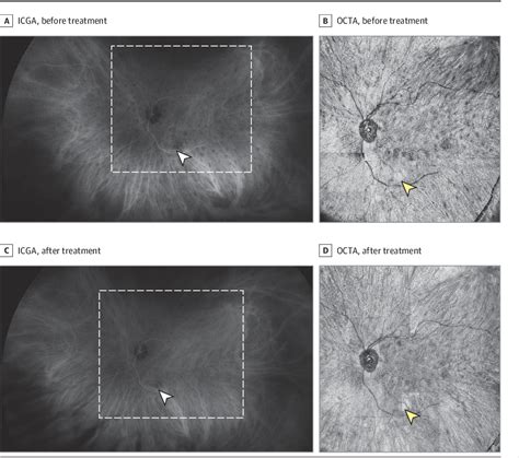 Figure 1 From Use Of En Face Swept Source Optical Coherence Tomography