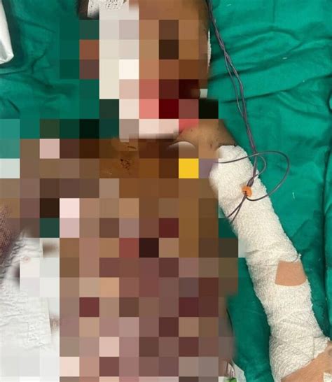 Dua Beradik Melecur Akibat Mercun Bola