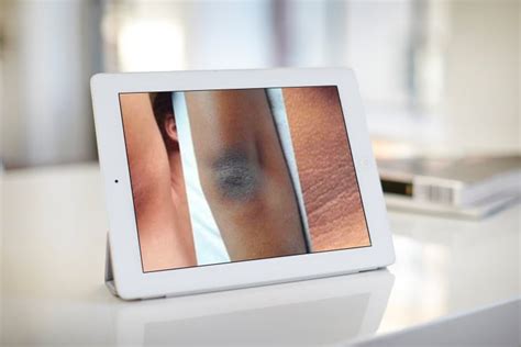 팔꿈치 겨드랑이 사타구니 착색 색소침착 원인과 관리법 네이버 블로그