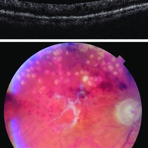 Significant Anterior Chamber Reaction With Hypopyon Download