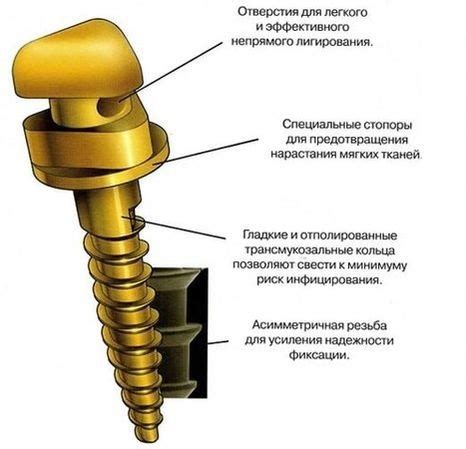Мини-винты - что это? | Стоматология Фларт