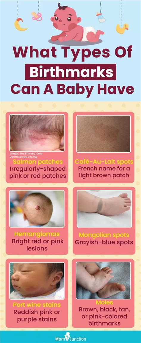Different Types Of Birthmarks Birthmark Removal Overview Cost