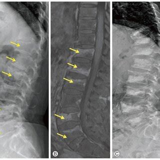 PDF Prevention And Treatment Of Multiple Osteoporotic Compression Fracture