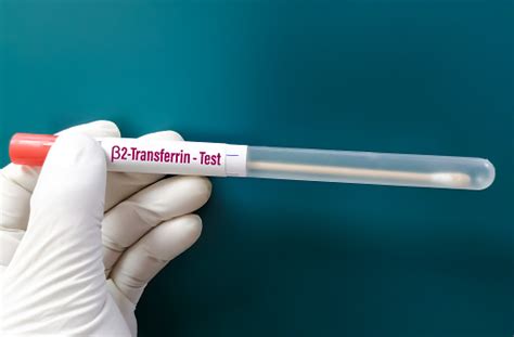 Nasal Fluid Sample Beta 2 Transferrin Test For The Diagnosis Of Csf Nasal Fluid Sample Beta 2 Transferrin Test For The Diagnosis Of Csf