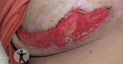 Pyoderma Gangrenosum Image