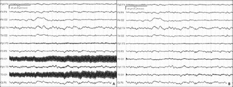 Eeg Pattern Recognition Flashcards Quizlet
