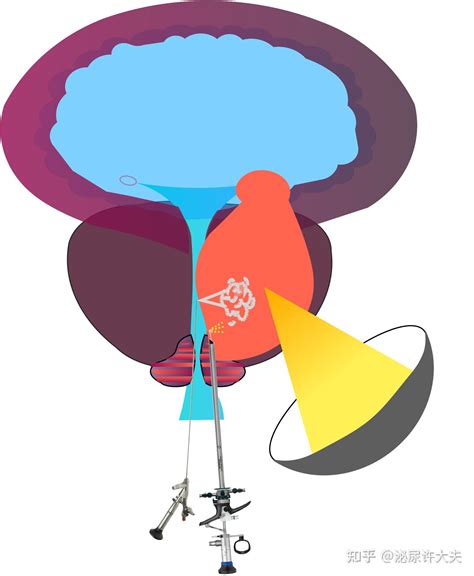 前列腺增生前列腺肥大微创治疗有哪些方法？ 知乎