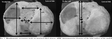 Figure 1 From Determination Of Sex Based On The Morphometric Evaluation Of The Proximal Tibia