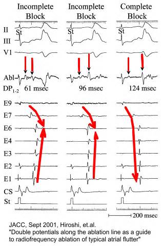 Ablation Of Atrial Flutter Icd Pcs Holdenaccounting