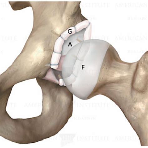 Pdf Arthroscopic Acetabular Labral Reconstruction A Review