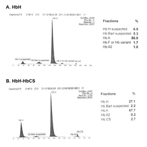 Typical Hemoglobin Analysis Of Patients With Hbh A And Hbh Hbcs B Download Scientific