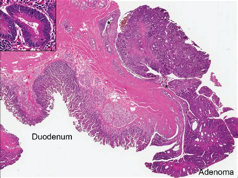 Duodenal Ampulla Histology