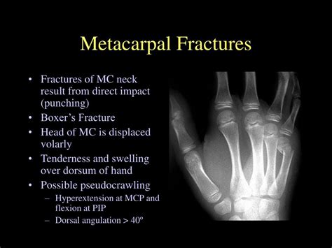 Metacarpal Fractures Assessment Management Teachmesur
