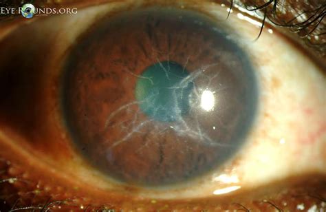 Atlas Entry Lattice Corneal Dystrophy