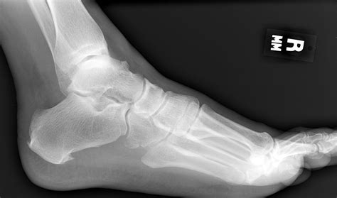 Cuboid Fractuur Heelkunde Protocollen