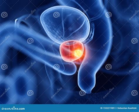 C Ncer De Pr Stata Stock De Ilustraci N Ilustraci N De Rendido