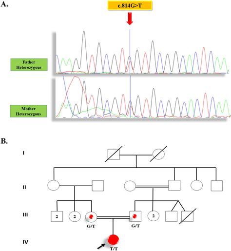 A Sanger Sequencing Chromatographs Shows Heterozygous Missense Variant