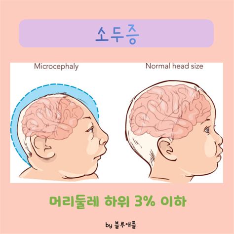 신생아 머리둘레 측정법 아기 평균 머리크기 대두증 소두증 네이버 블로그