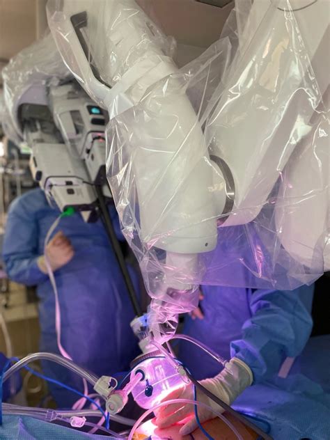 Single Port Partial Nephrectomy Techniques And Outcomes