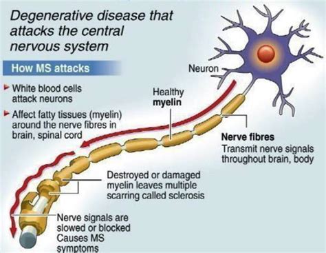 Multiple Sclerosis And Exercise Pivotal Physio
