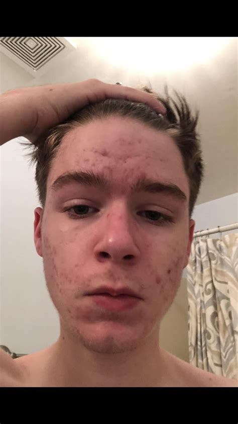 6 Months On Accutane So Happy With The Results R Accutane