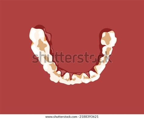 Gingivitis Inflammation Gums Dental Calculus Infographics Stock Vector Royalty Free 2188393621