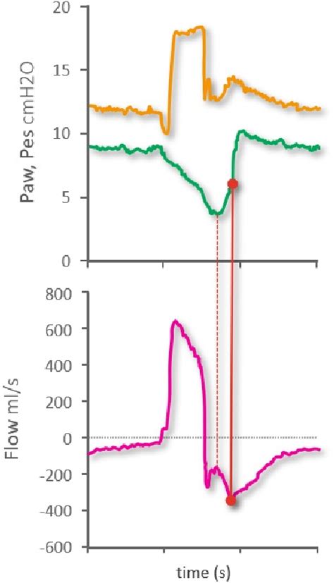 Figure 1 From Using Waveforms To Identify Asynchronies Step 2 Semantic Scholar