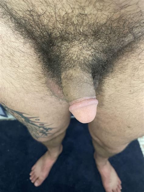 8 Weeks Post Revision And Scrotoplasty Rcircumcision