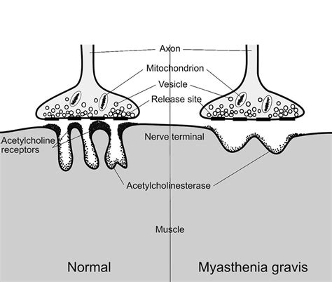 Anaesthesia And Myasthenia Gravis Wfsa Resources