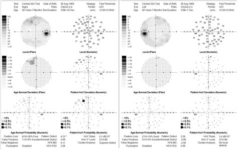 Bilateral Pigment Dispersion Glaucoma Scope Connect