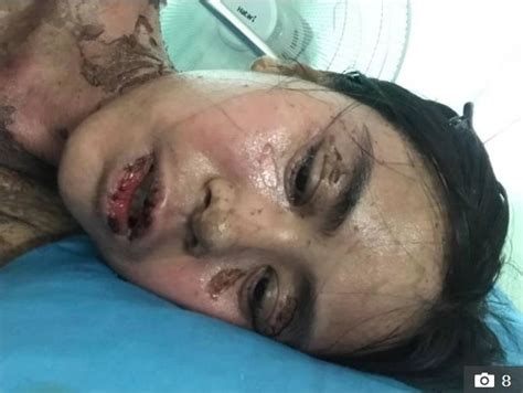 S C V I H Nh Nh C G I B D Ng To N Th N M T Bi N D Ng Do D Ng Thu C Ch A Au R Ng Khi N