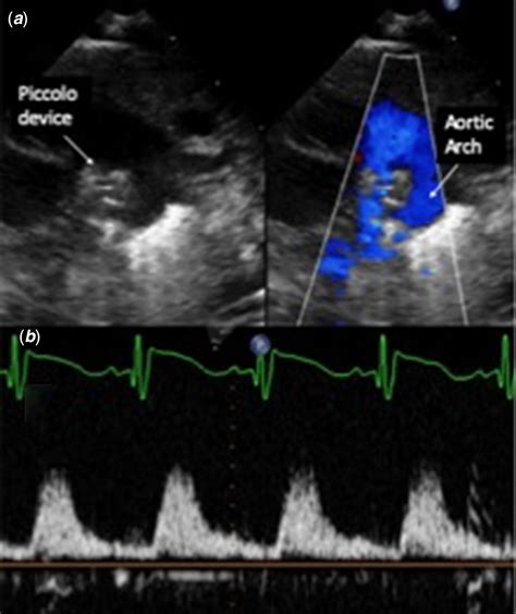 Aortic Migration Of Amplatzer Piccolo™ Ductal Occluder Cardiology In The Young Cambridge Core