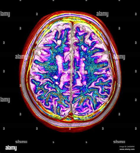 Multiple Sclerosis Coloured Axial Magnetic Resonance Imaging MRI