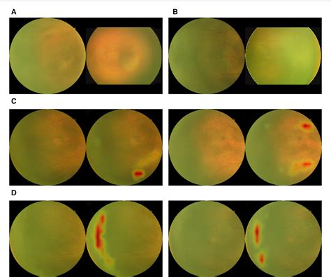 Figure 3 From Development And Validation Of An Artificial Intelligence Based Screening Tool For