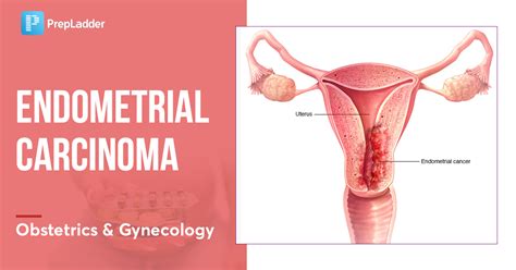Uterus Cancer Pictures Differences Between Endometrial Cancer And