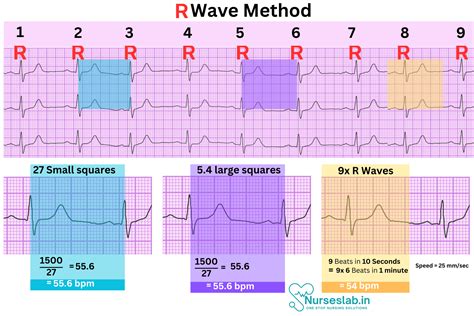 Calculating Heart Rate On An Ecg Explained