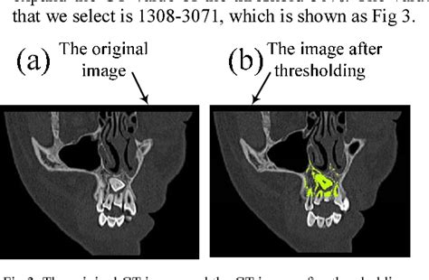 Figure 1 From A Novel Finite Element Modeling Method For Periodontal Ligament Of Impacted
