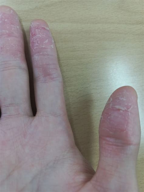 손이 너무 아파 ㅠㅠ 연예인잡담 에펨코리아